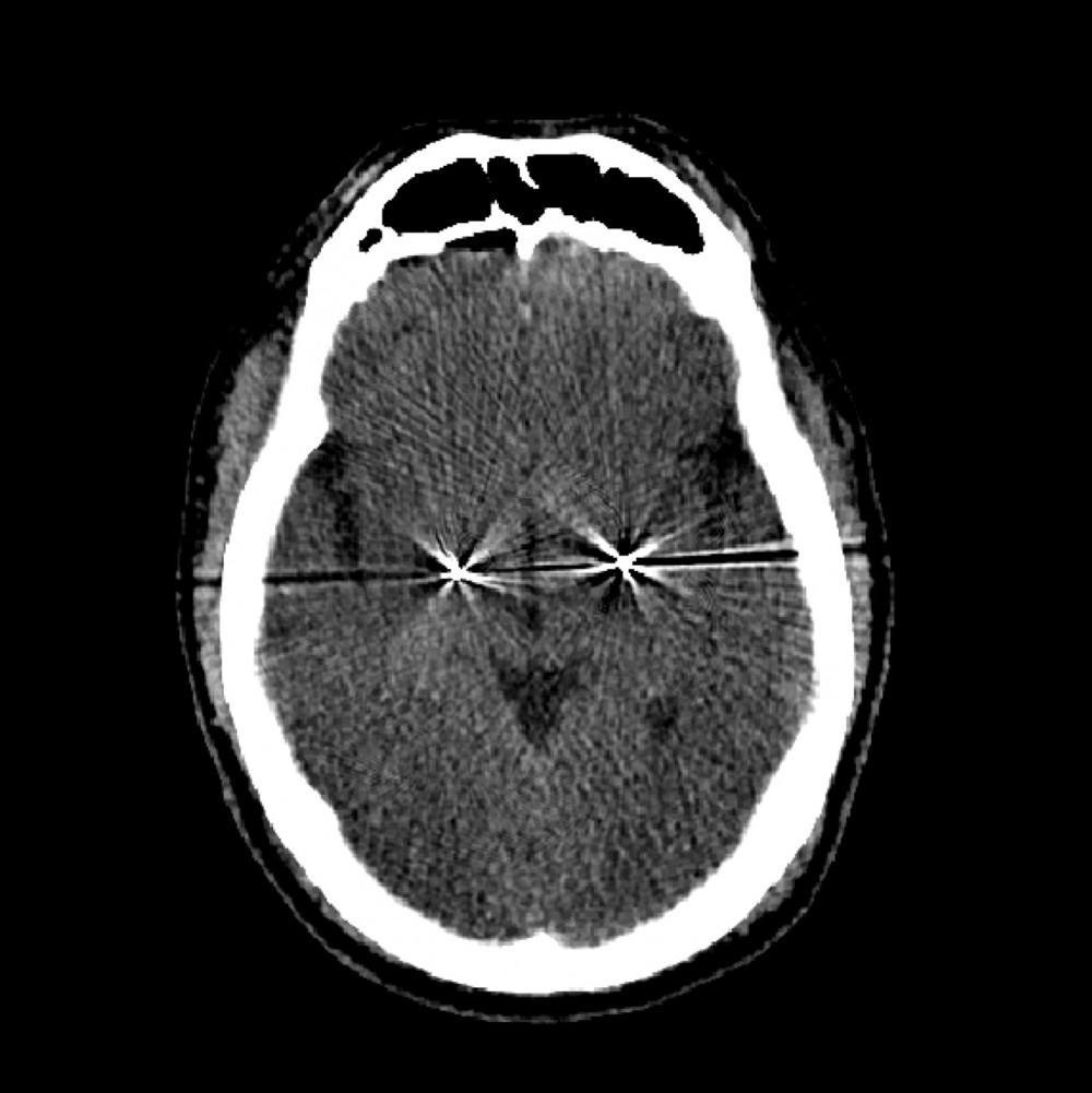 Parkinson’s Disease and Deep Brain Stimulation (DBS) with Dr. Mian ...