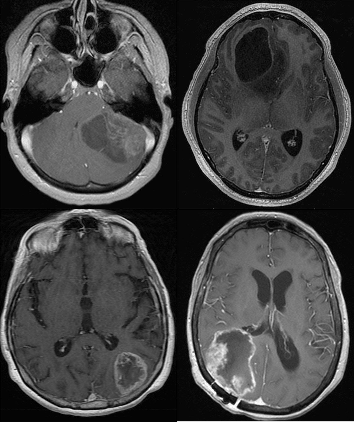 Glioma with Dr. Arias - CarePoint Neurosurgery and Spine